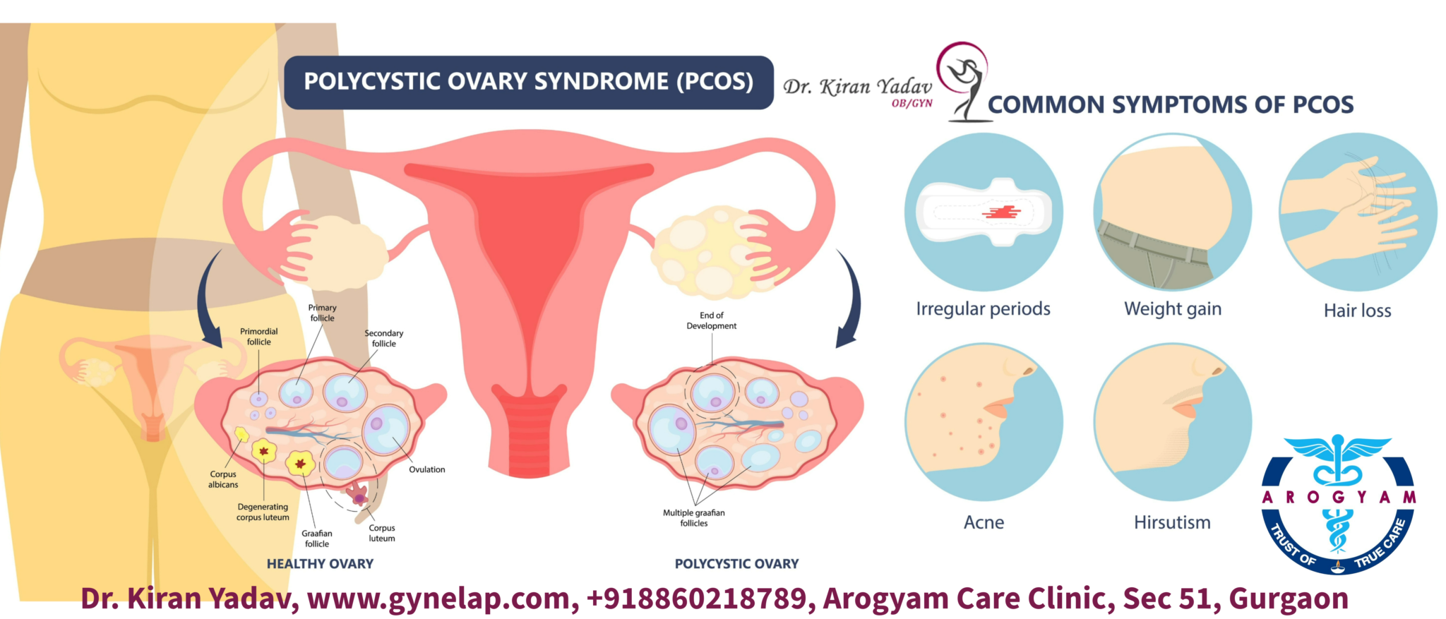 Understanding PCOD and PCOS: Treatment and Self-Care